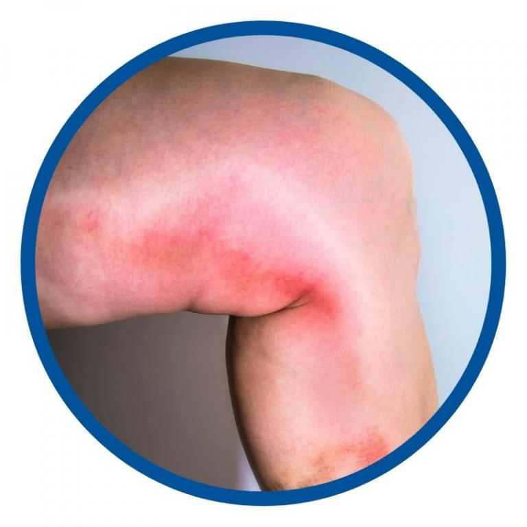 Vein Disease | Superficial Thrombophlebitis | USA Vein Clinics
