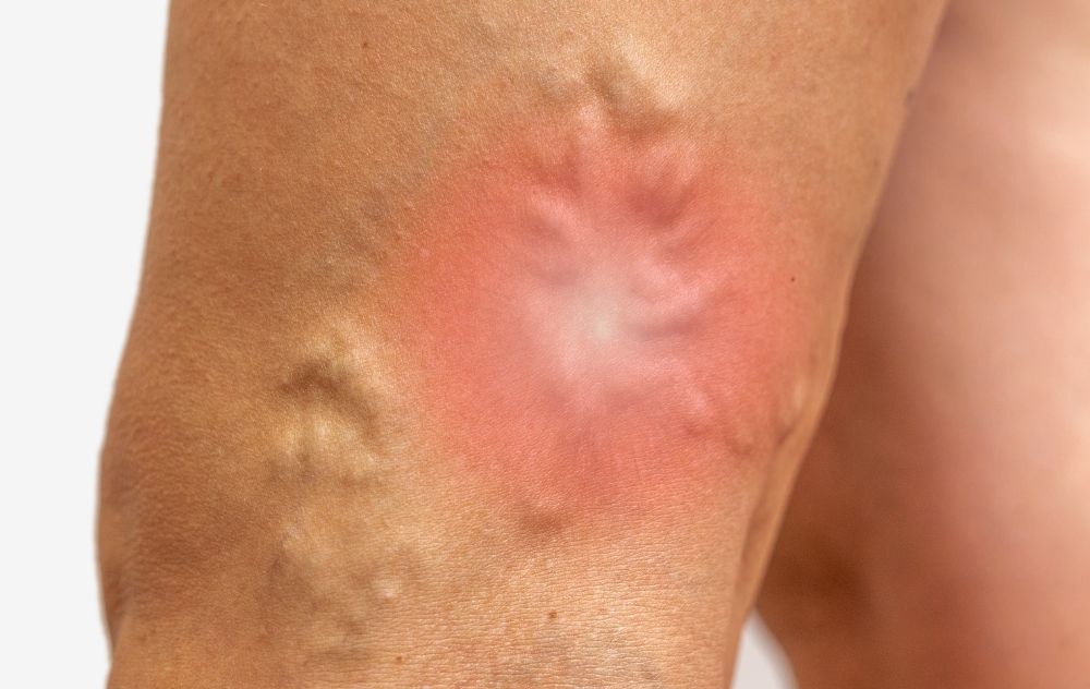 What Causes A Burning Sensation In The Legs?