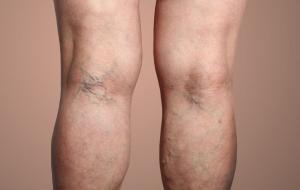 Common Vein Problems In Legs | America's Vein Experts | Vein Care