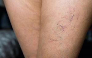 What Causes Your Veins To Show? | America's Vein Experts | Vein Care