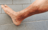 Signs You Have A Burst Vein | America's Vein Experts | Vein Care
