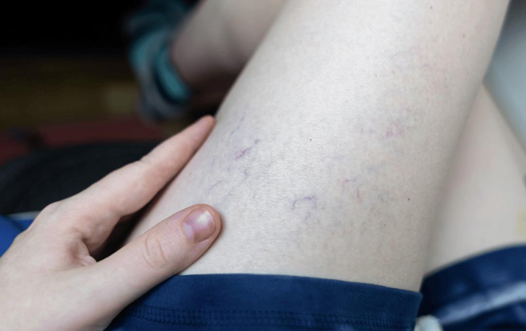 Venous Stasis Vs. Varicose Veins: What’s The Difference? | America's ...