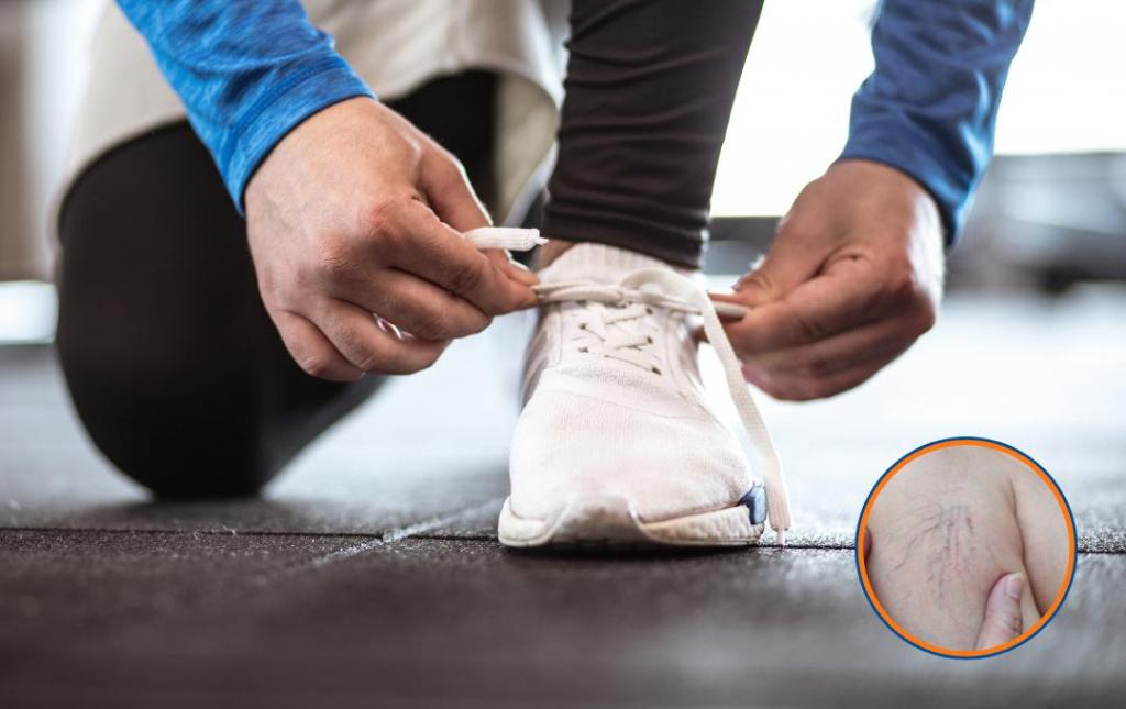 Does Working Out Help Or Hurt Spider Veins? | America's Vein Experts ...