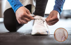 Does Working Out Help Or Hurt Spider Veins? | America's Vein Experts ...