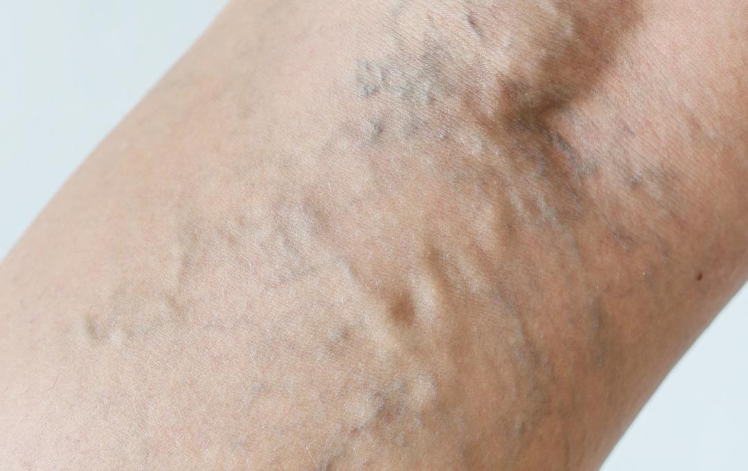 Why Do My Varicose Veins Feel Warm? | America's Vein Experts | Vein Care